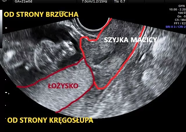 Łożysko w ciąży - jak o nie dbać, co mówi jego lokalizacja?