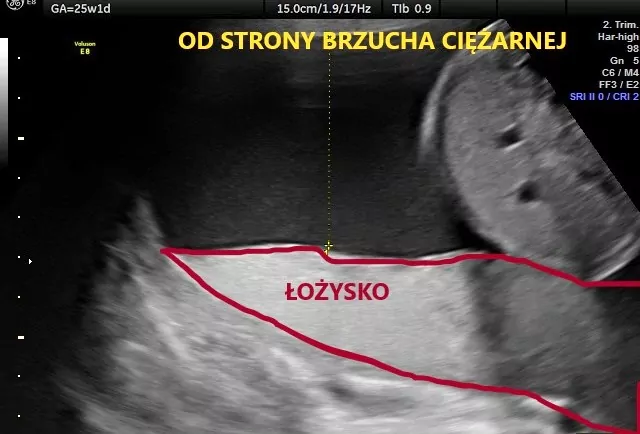 Łożysko w ciąży - jak o nie dbać, co mówi jego lokalizacja?