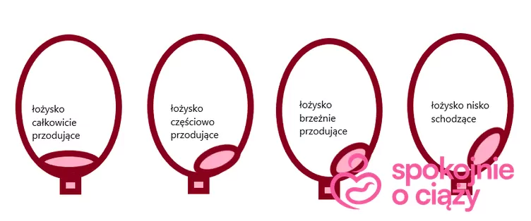 Łożysko na ścianie przedniej a łożysko przodujące - jaka różnica?